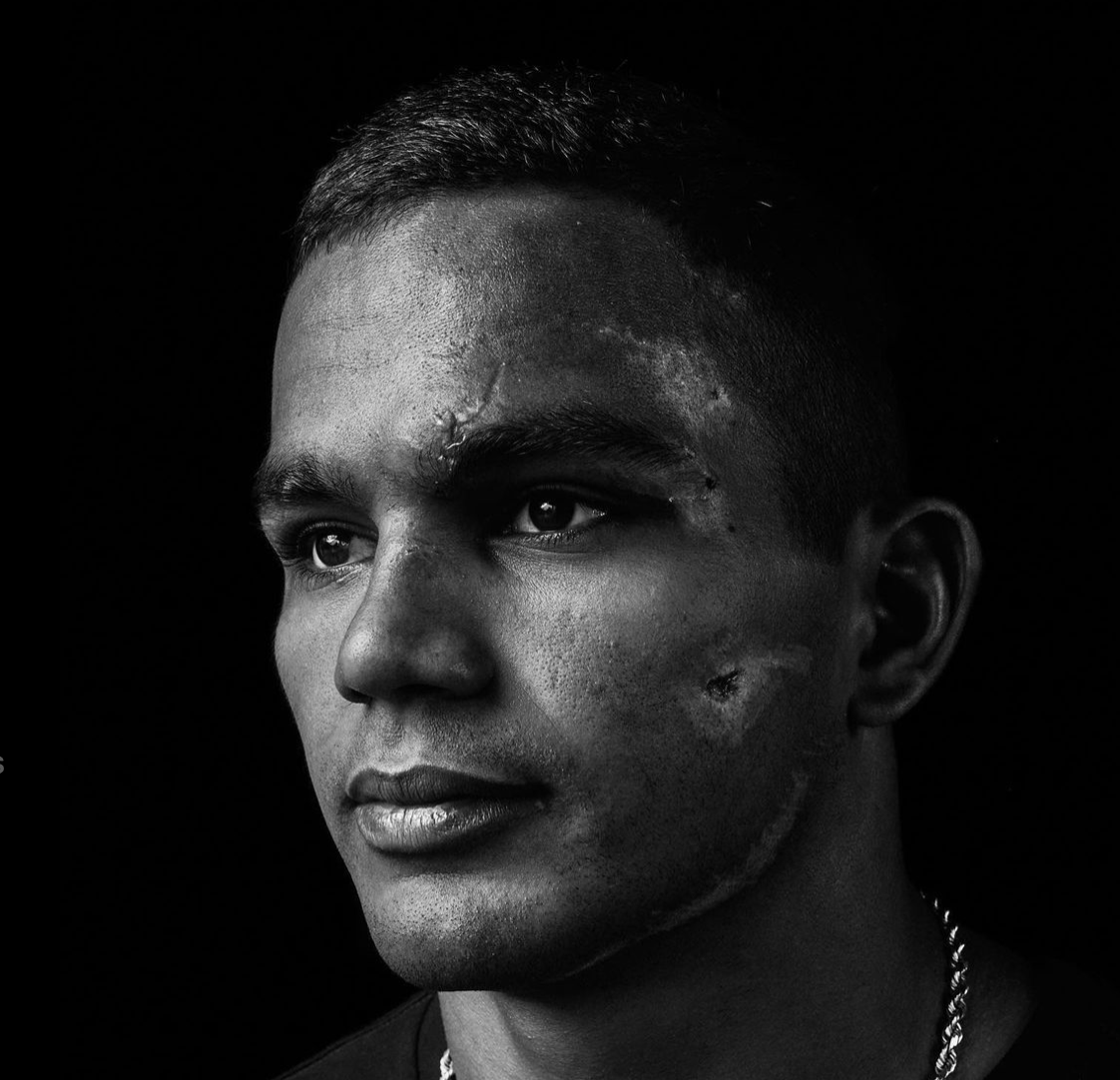 War Story: Kala Grace's Comeback From A Near-Fatal Injury At Pipeline ...